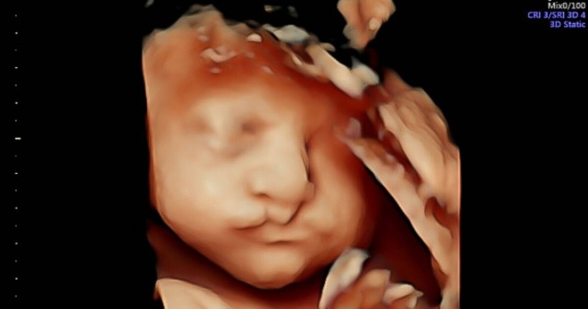 Baby Glimpse - echo pretecho - Blog Schisis - Baby Glimpse